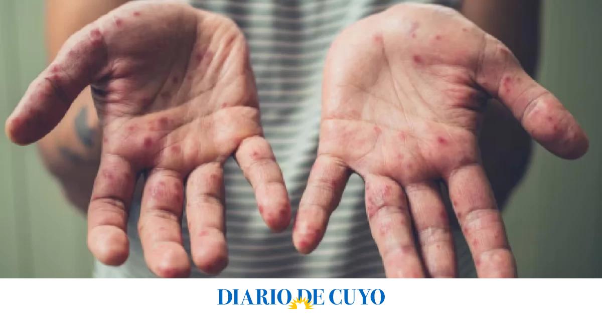 Alerta epidemiológica en CABA: confirmaron el cuarto caso de sarampión ...